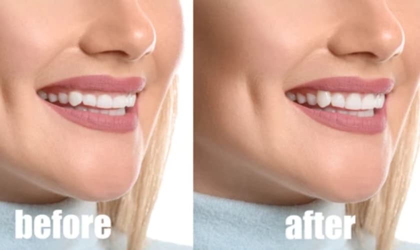 When is Gum Sculpting Recommended? Common Indications