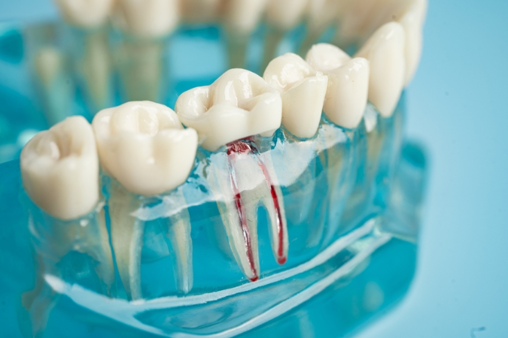 Three Types of Root Canal Procedures